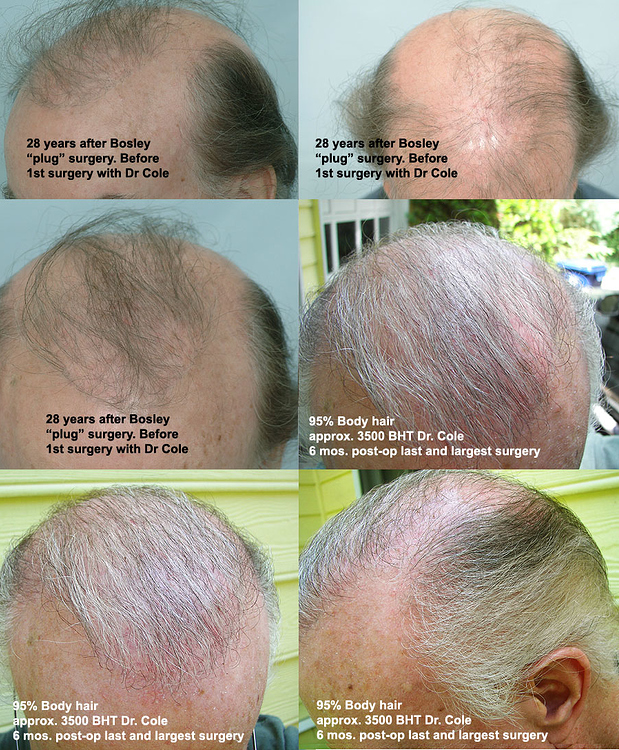 Progress Photos 6 mos post op - Hair Transplant - HairSite - Hair ...