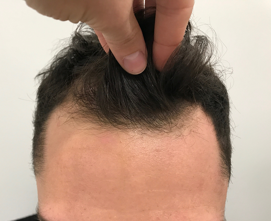 Topical Liposomal Finasteride hair loss treatment - Topicals - HairSite ...