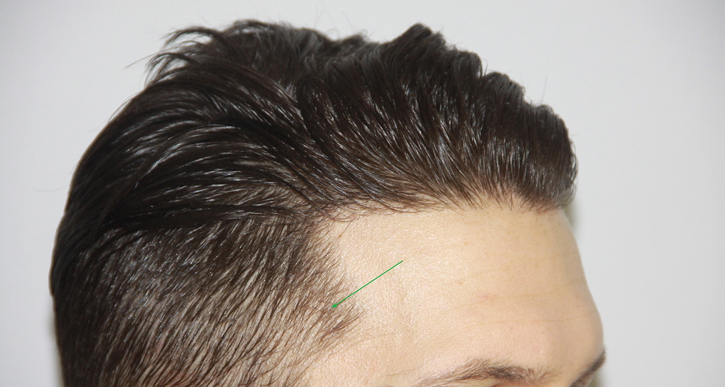 The importance of temple points in hair restoration - Dr. Baubac ...