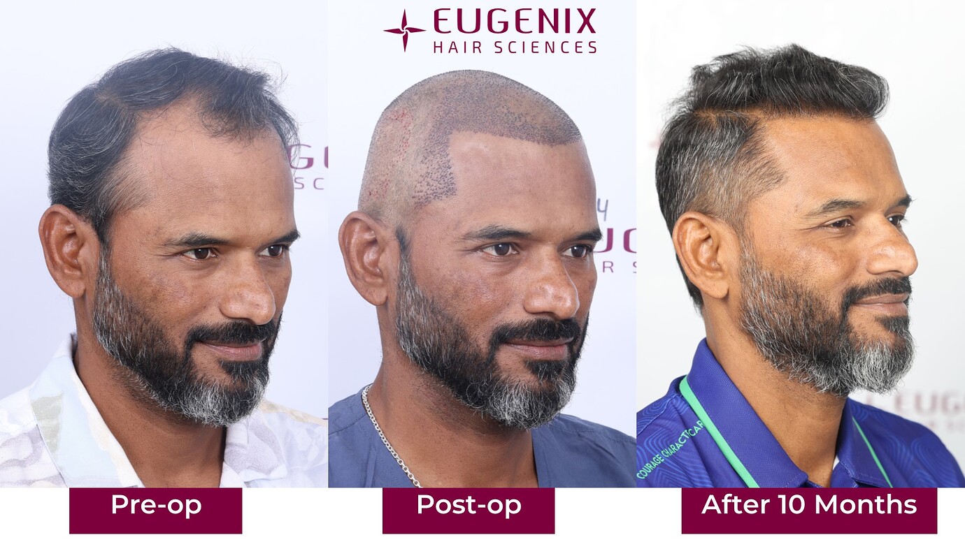 Eugenix Hair Sciences | NW 5V | 3,632 Grafts | 10 Months Hair ...