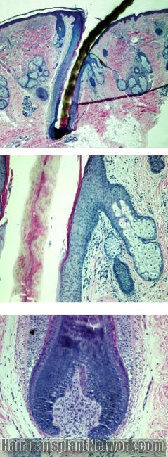 Hair Follicle Miniaturization Irreversible in AGA? The point-of-no ...