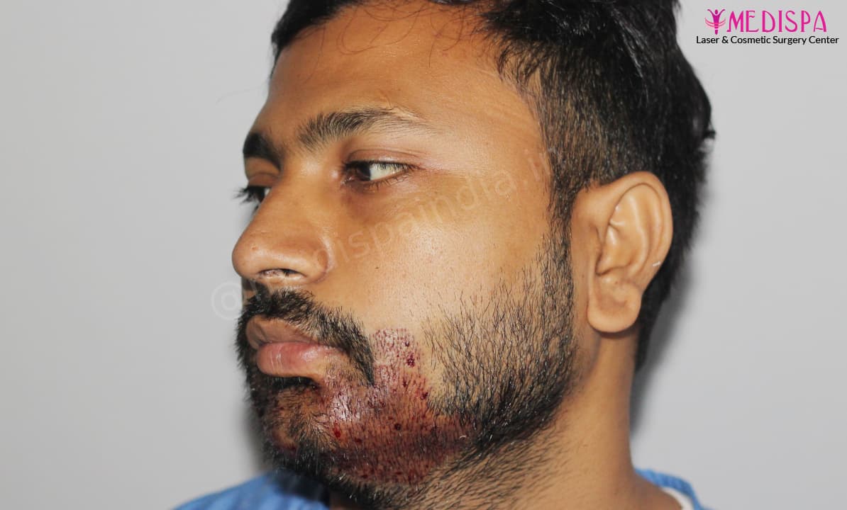 Facial Burn Scar, Beard Reconstruction by Dr. Suneet Soni – 2704 Grafts ...